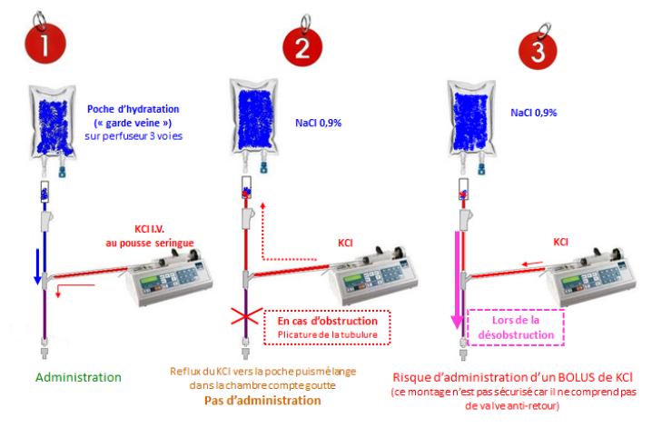 Cas clinique (4) : Attention au risque de bolus de KCl non souhaité ! [Prévenir les erreurs ...
